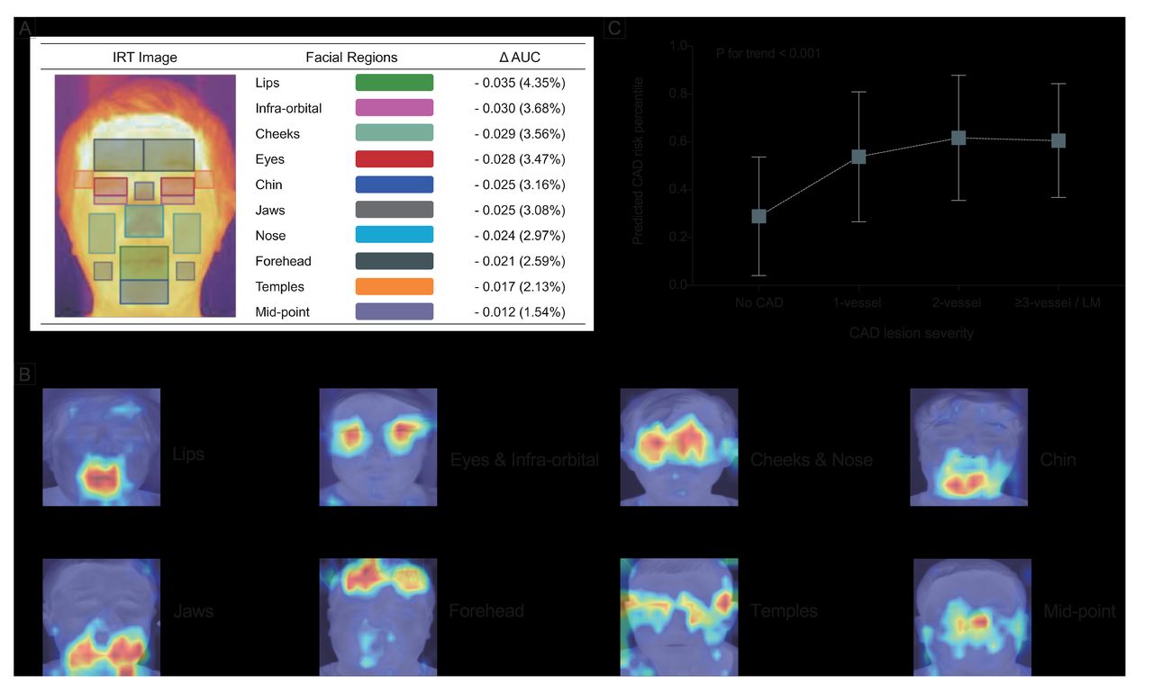 Prediction of coronary artery disease based on facial temperature ...